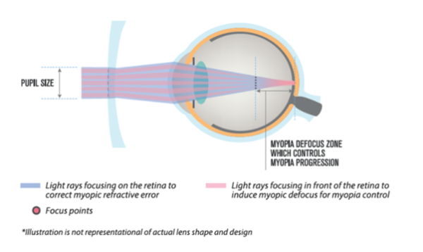 How MiYOSMART Lenses Helps to Control Myopia - OJO, KAIJOO